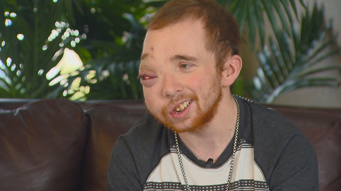 Lucas McCulley's post-surgery look revealed: 'It feels like I have got ...