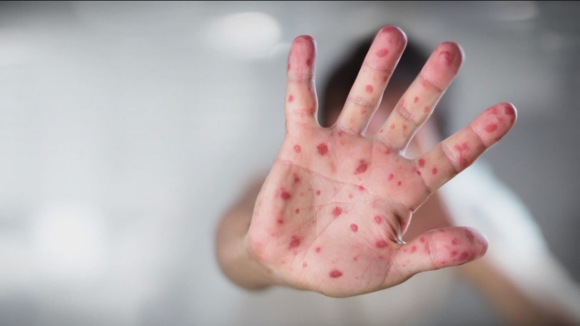 Unvaccinated children with measles attend Vallivue Middle and High ...