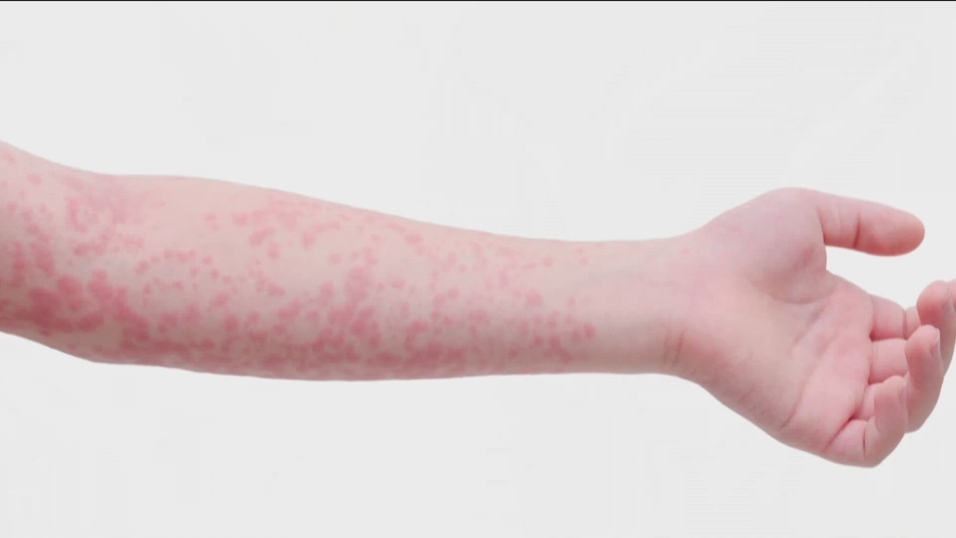 Unvaccinated children with measles attend Vallivue Middle and High ...